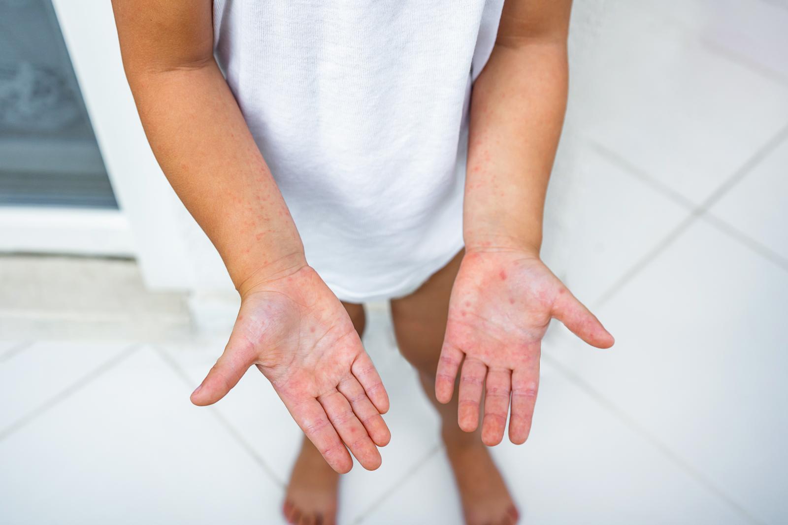 Ini dia Virus Penyebab Anak Terkena Flu Singapura